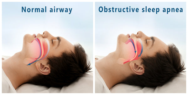 CAUSES AND SYMPTOMS OF OBSTRUCTIVE SLEEP APNEA – Sleepgram